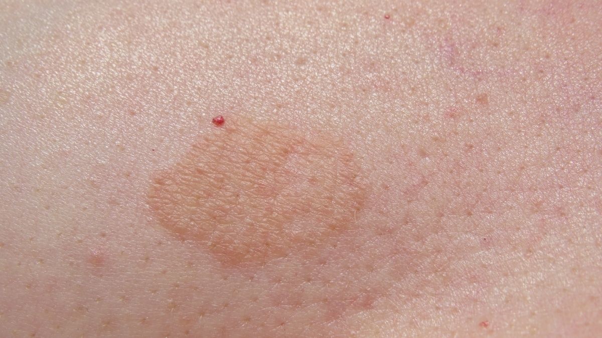 Waspada, Penderita Obesitas Rentan Terkena Jamur Kulit - KlikDokter