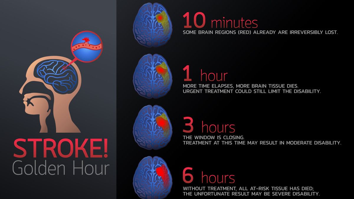 Ketahui ‘Golden Hour’ Penanganan Stroke demi Mencegah Dampak Fatal ...
