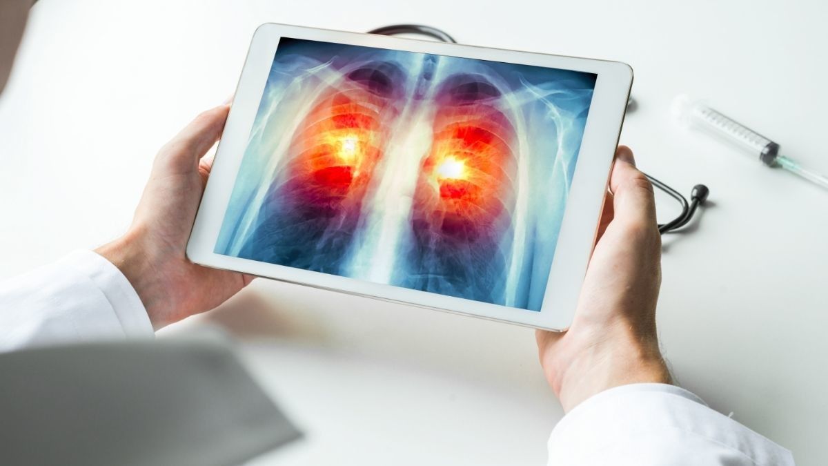 Seberapa Cepat Kanker Paru Menyebar ke Organ Lain? - KlikDokter