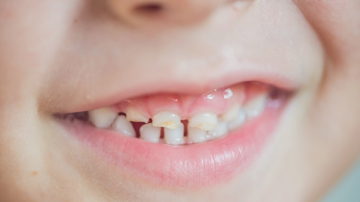 3 Perawatan untuk Mengatasi Gigi Kecil atau Microdontia - KlikDokter