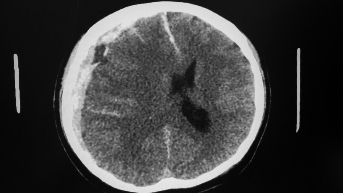 Mengenal Penyakit Hematoma Subdural, Perdarahan di Lapisan Otak ...