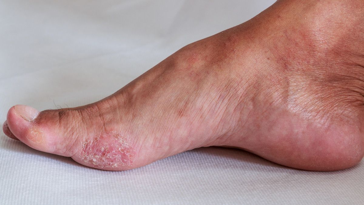 Komplikasi Diabetes yang Harus Anda Waspadai - KlikDokter