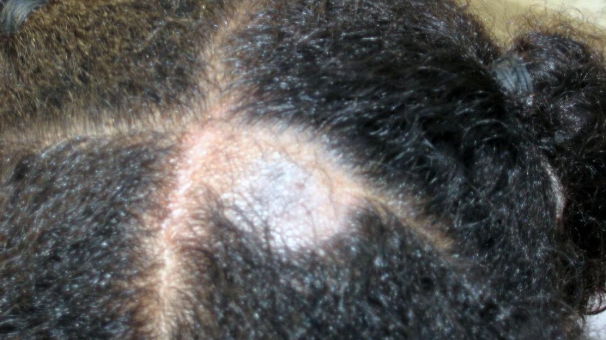 Jenis Jamur dan Gejala Infeksi yang Ditimbulkannya - KlikDokter