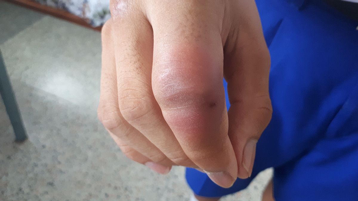 10 Penyebab Jari Bengkak yang Perlu Anda Tahu - KlikDokter