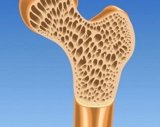 Bagaimana Osteoporosis Terjadi? - KlikDokter
