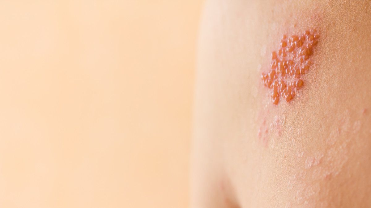 Beda Antara Herpes Zoster dan Herpes Simpleks - KlikDokter