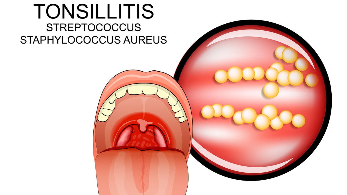 Radang Tenggorokan Bisa Merusak Jantung dan Ginjal - KlikDokter