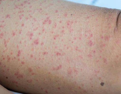 scrofuloderma adalah