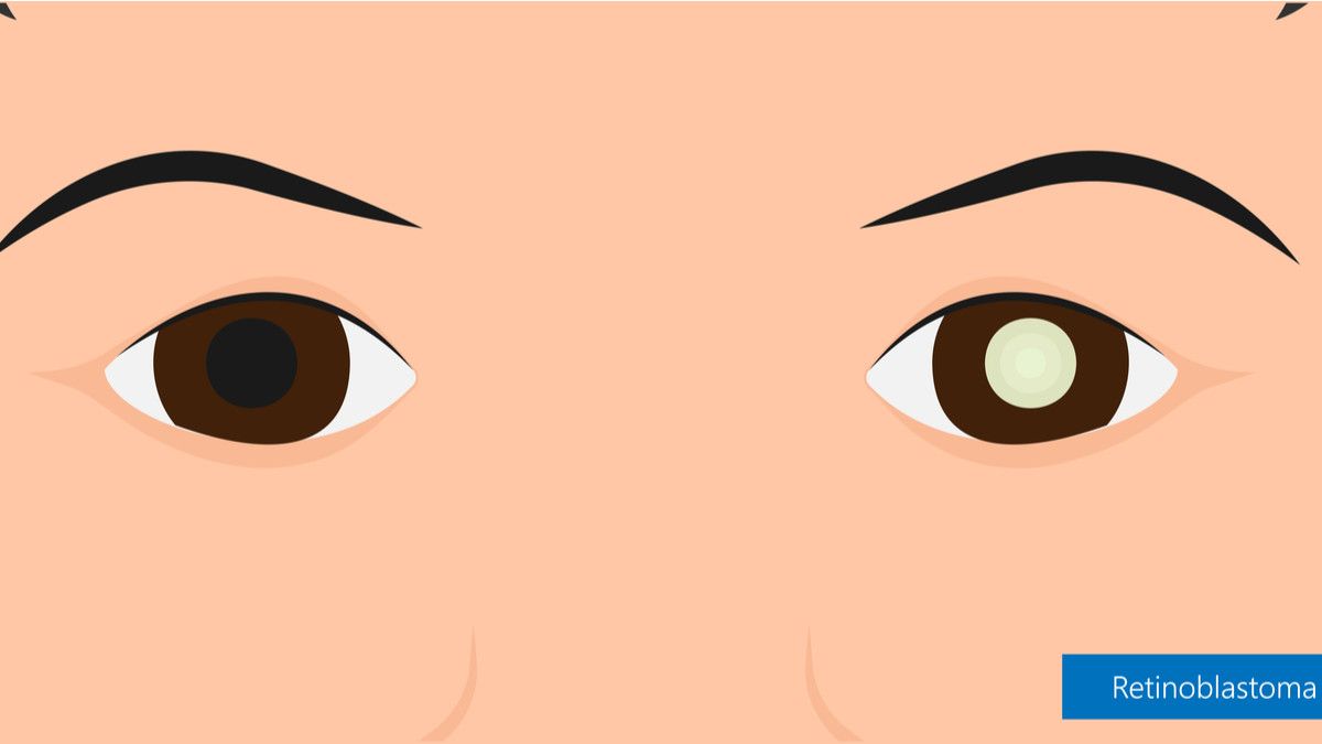 Retinoblastoma Timbulkan Kebutaan Permanen Pada Anak - KlikDokter