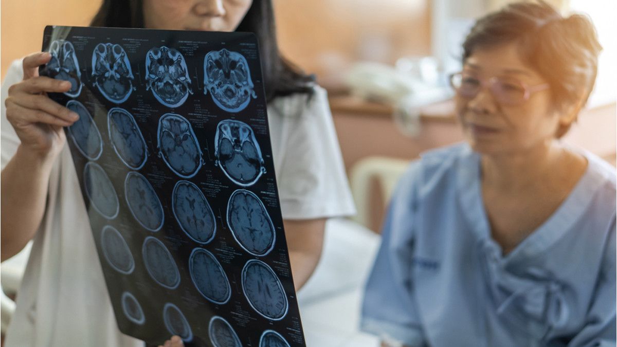 Metode FAST, Cara Mudah Deteksi Penyakit Stroke - KlikDokter