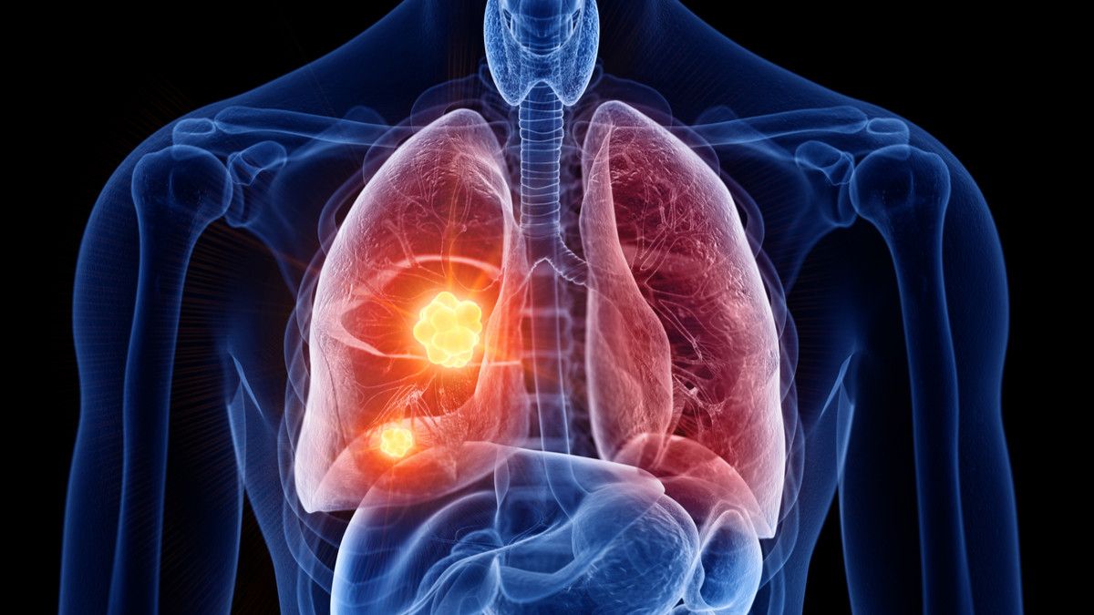 Penyebab Kanker Paru, Tak Hanya dari Rokok - KlikDokter
