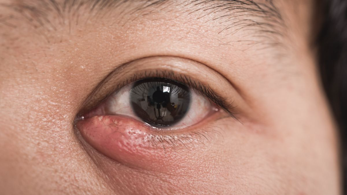 8 Penyebab Mata Belekan Terus-Menerus - KlikDokter