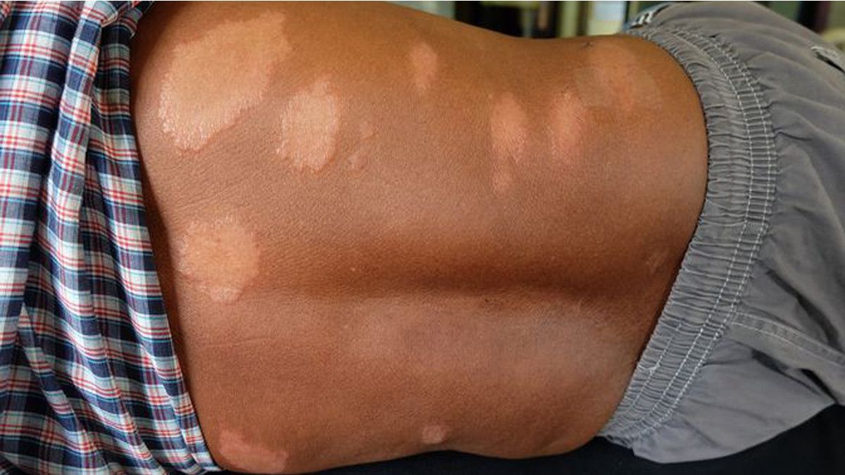 Yuk, Kenali Bakteri Penyebab Kusta - KlikDokter