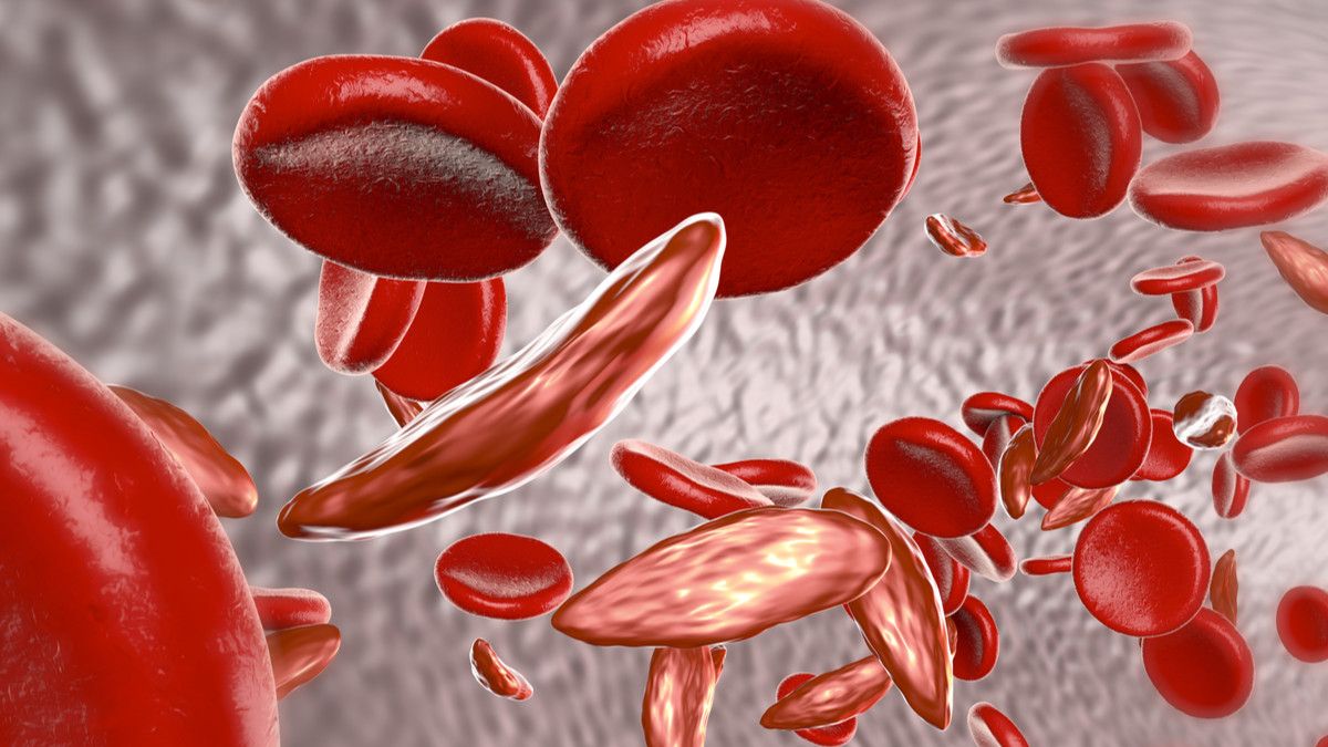 5 Fakta Anemia Sel Sabit yang Jarang Diketahui - KlikDokter
