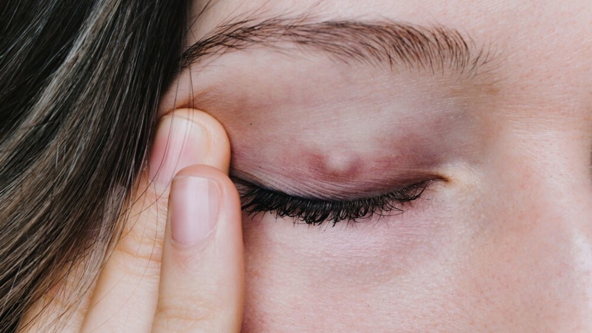 Stres Jadi Penyebab Bintitan, Mitos atau Fakta? - KlikDokter