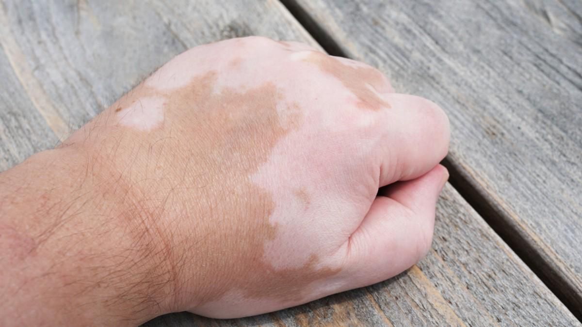 4 Penyebab Bercak Putih pada Kulit Anak - KlikDokter