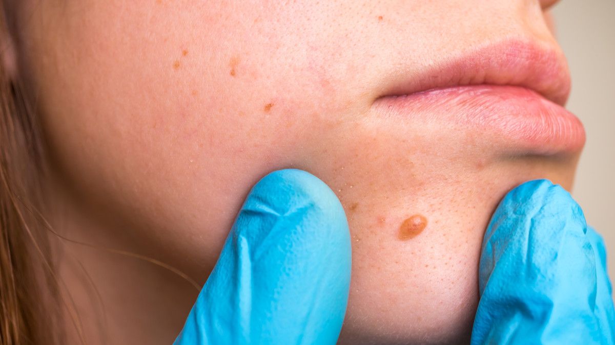 8 Kelainan pada Kulit yang Jadi Tanda Penyakit Serius - KlikDokter