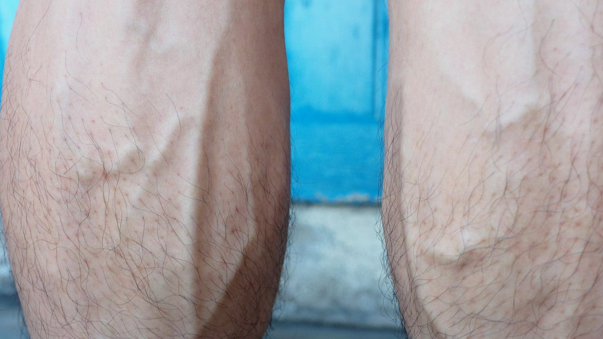 7 Penyebab Urat Menonjol di Kulit, Berbahayakah? - KlikDokter