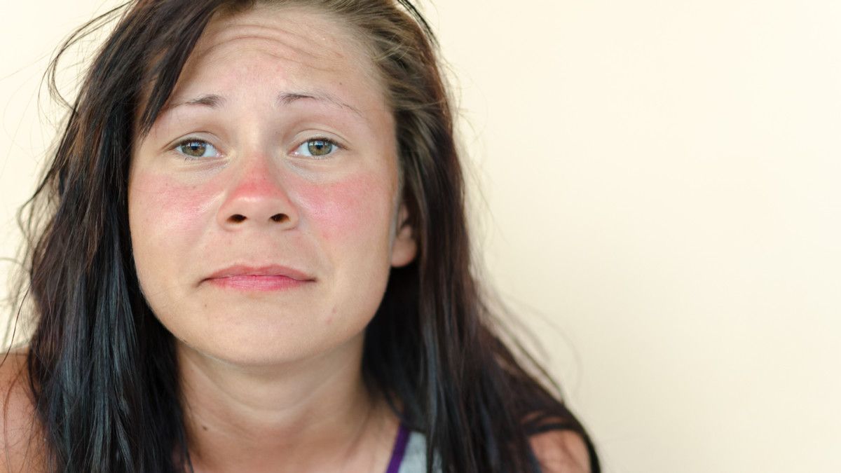 Ini Ciri-Ciri Kulit Wajah yang Terkena Merkuri - KlikDokter