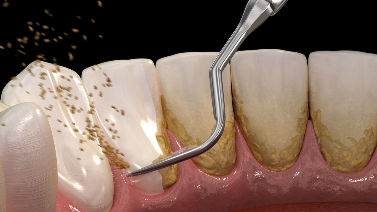 10 Alat Dokter Gigi dan Fungsinya - KlikDokter