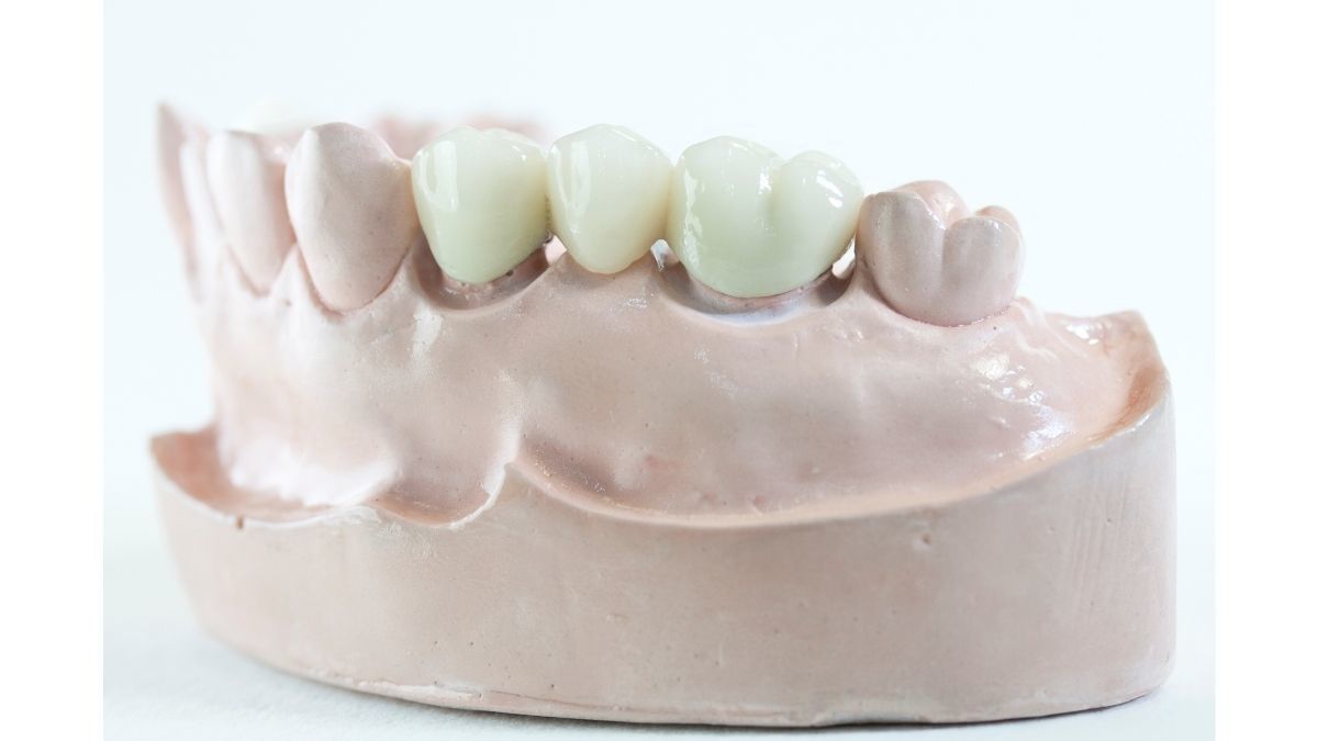 Mengenal Dental Bridge, Gigi Palsu Permanen yang Nyaman Digunakan ...
