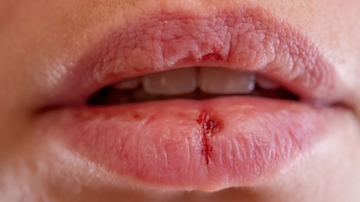 Penyebab Bibir Terasa Kebas dan Kesemutan - KlikDokter