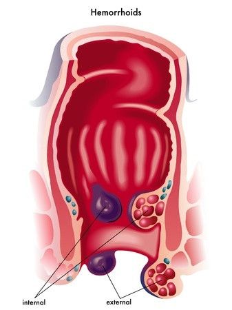 Kenali Gejala dan Penyebab Wasir - KlikDokter