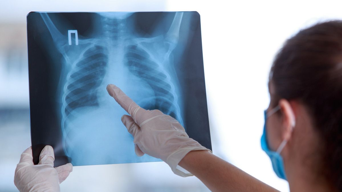 Tipe-tipe Pneumonia yang Harus Diketahui - KlikDokter