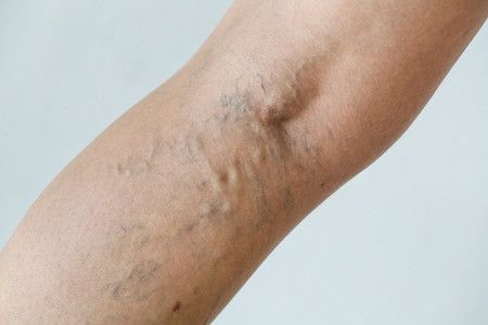 Varises Saat Hamil - KlikDokter