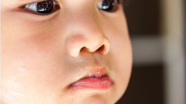 Hidung Sering Ingusan, Gejala Sinusitis? - KlikDokter