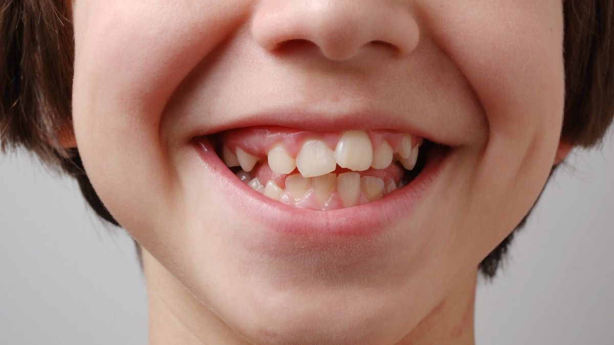 Kenali Ciri-Ciri Gigi Gingsul pada Anak, Bisakah Dicegah? - KlikDokter