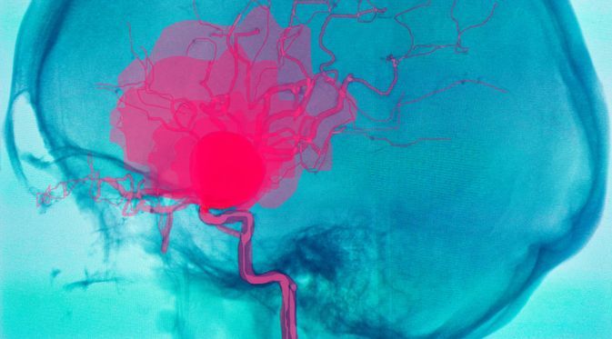 Radang Otak - Penyebab, Gejala dan Pengobatan - KlikDokter