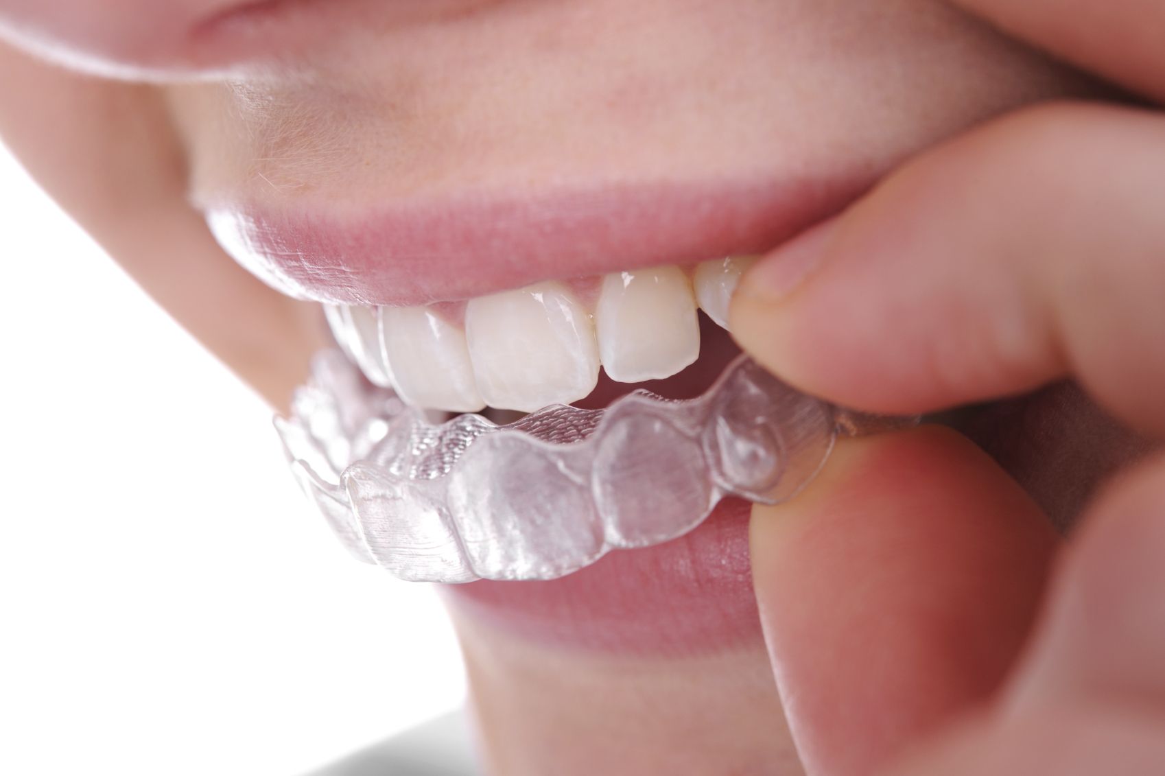 Merapikan Gigi dengan Invisalign atau Kawat Gigi, Ini Bedanya! - KlikDokter