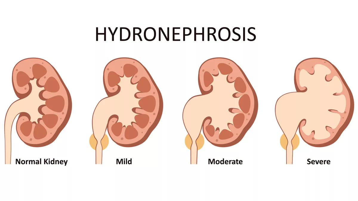 Hidronefrosis - Penyebab, Gejala, Pengobatan - KlikDokter
