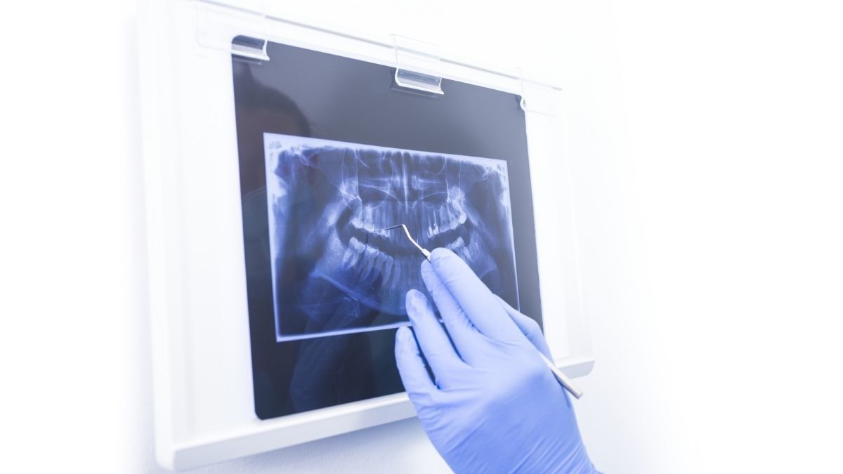 Mengenal Penyebab Spikula Tulang Gigi dan Cara Mengatasinya - KlikDokter