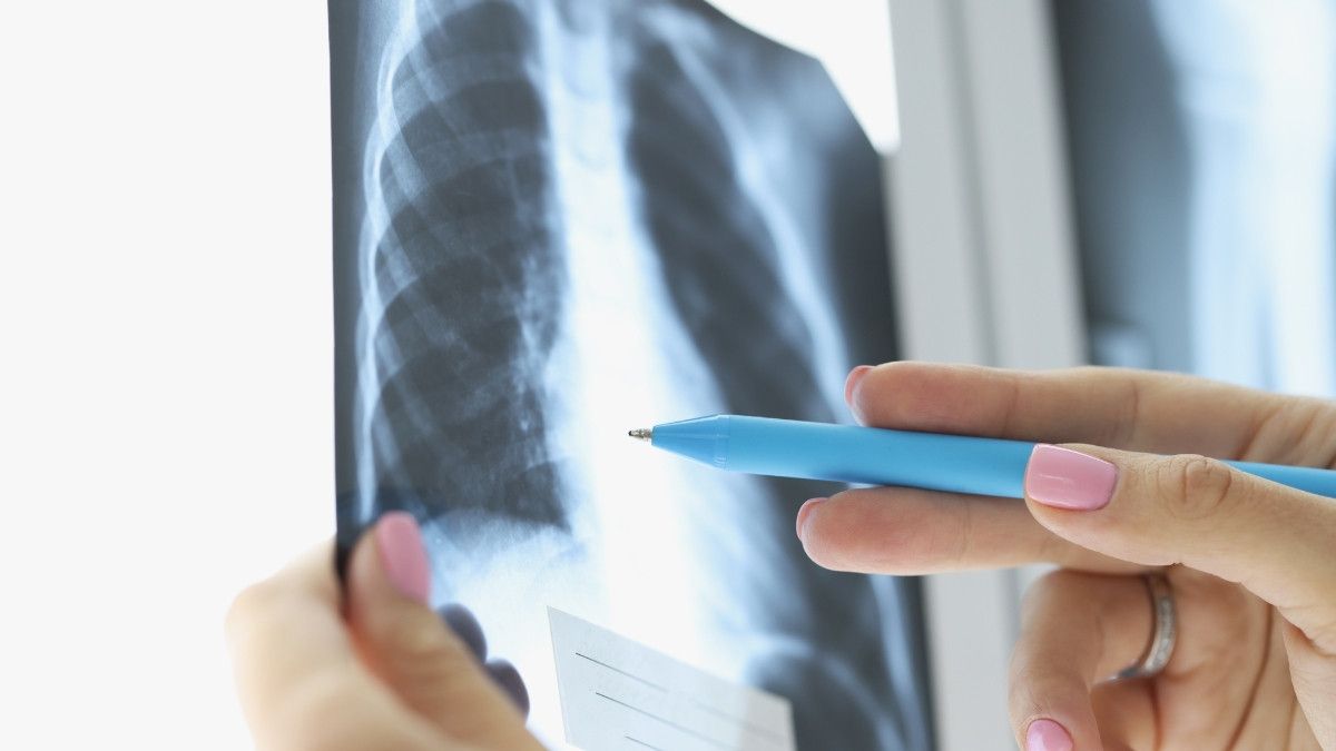 Komplikasi Emboli Paru yang Harus Diwaspadai - KlikDokter