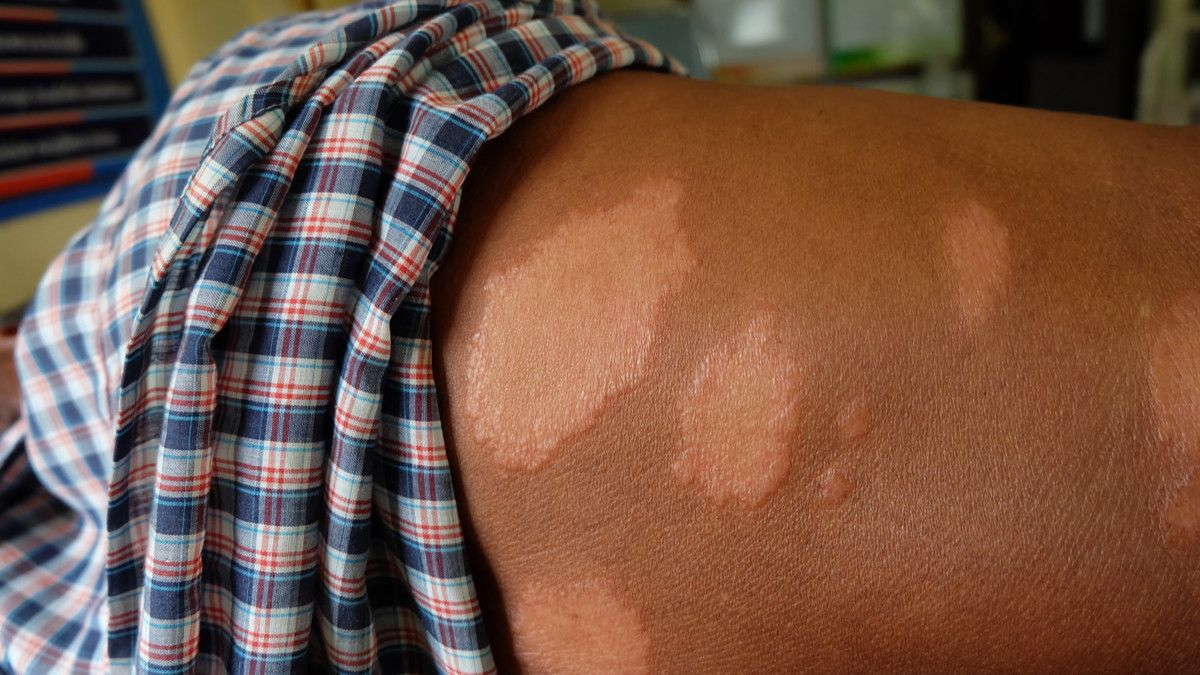 4 Penyebab Bercak Putih pada Kulit Anak - KlikDokter