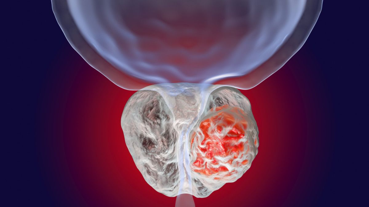 Kenali Gejala Kanker Prostat yang Dialami Arswendo Atmowiloto - KlikDokter
