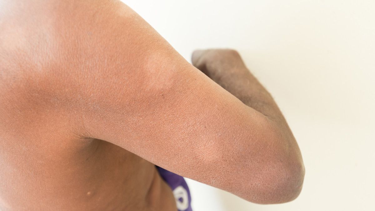 Indonesia Ranking 3 Penderita Kusta Terbanyak di Dunia - KlikDokter