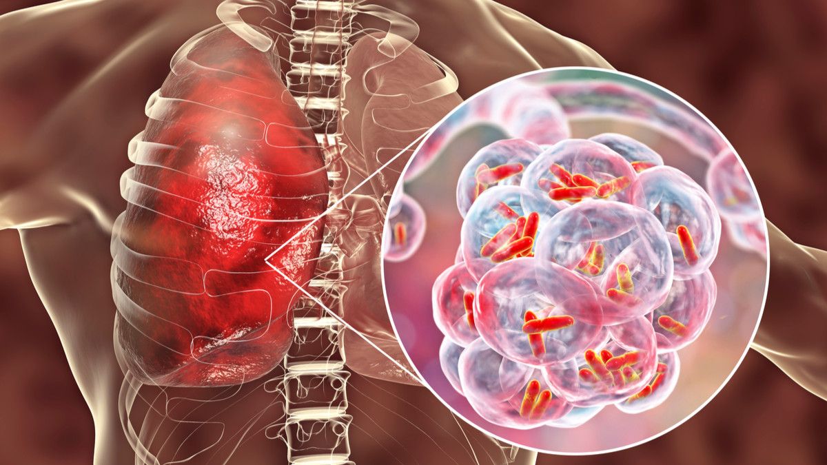 Fakta Tentang Pneumonia yang Perlu Anda Tahu - KlikDokter