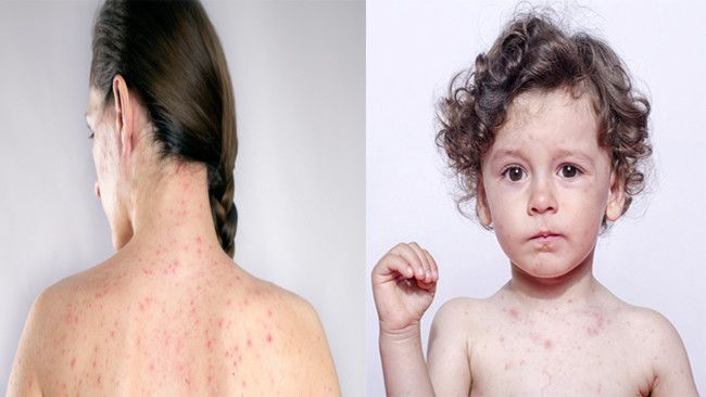 Apa Beda Campak pada Anak dan Orang Dewasa? - KlikDokter