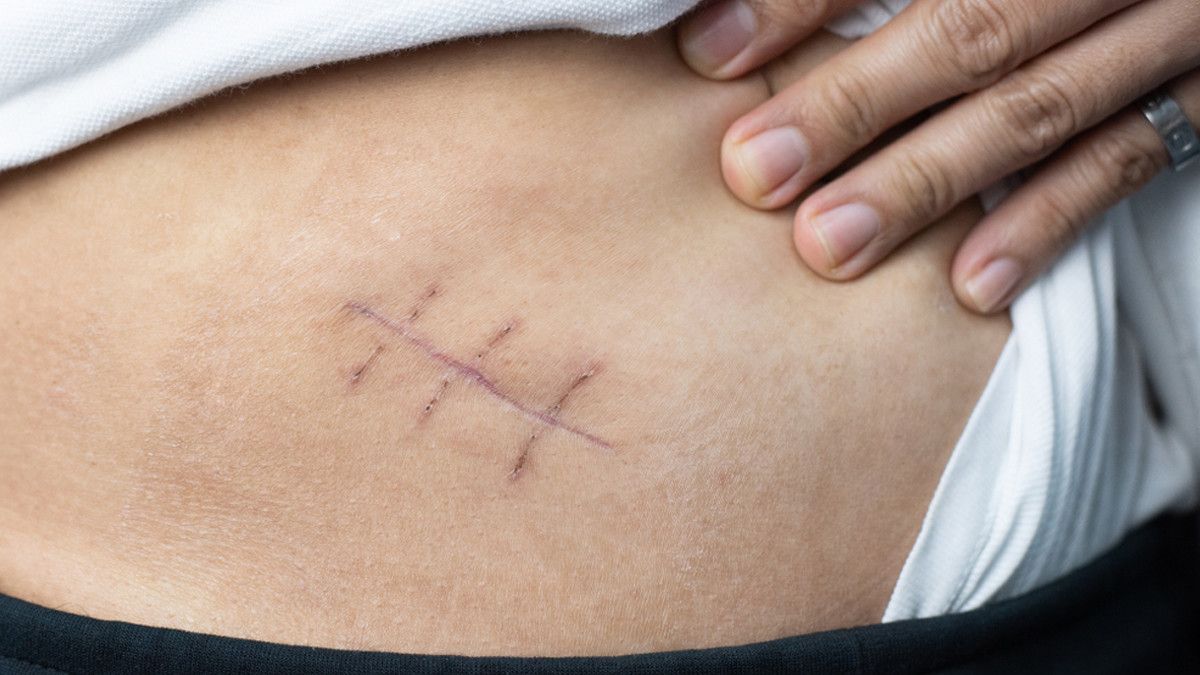 Waspada, Ini 8 Efek Samping Operasi Usus Buntu - KlikDokter