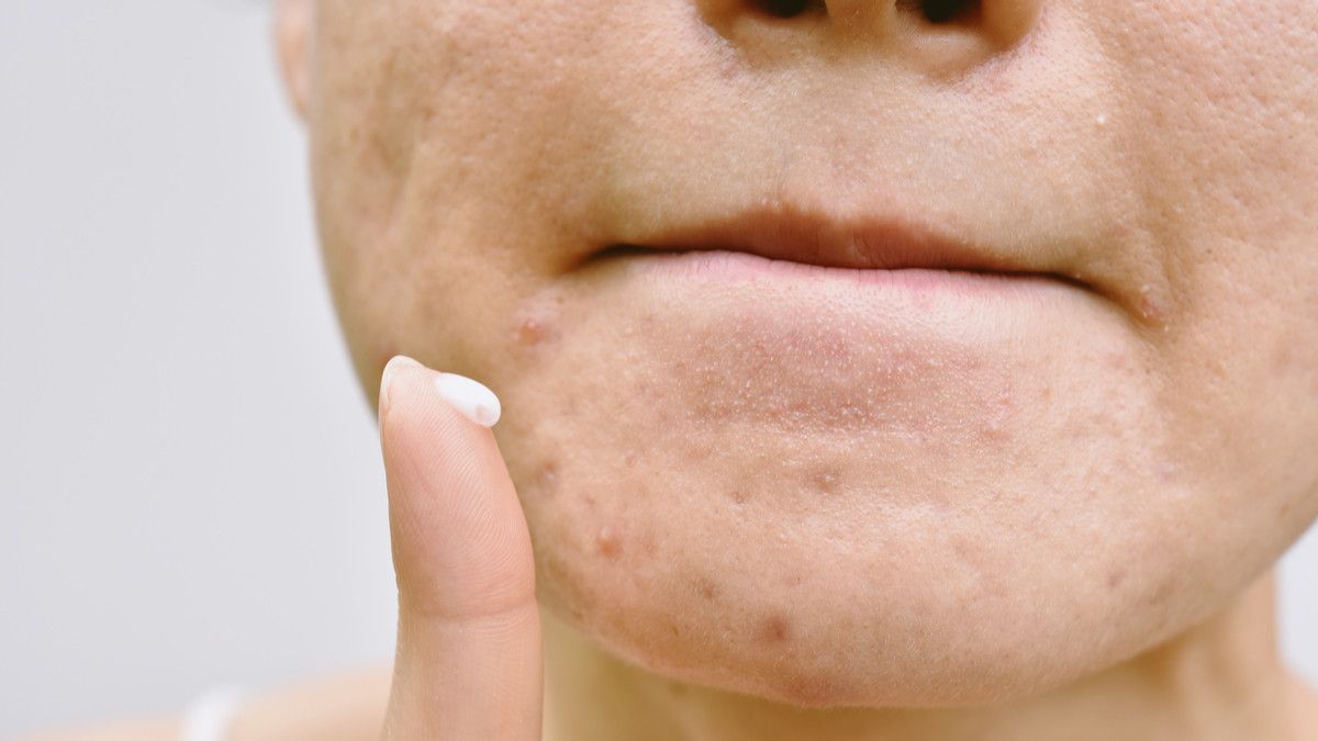 Mengenal Perbedaan Jerawat Purging dan Breakout - KlikDokter