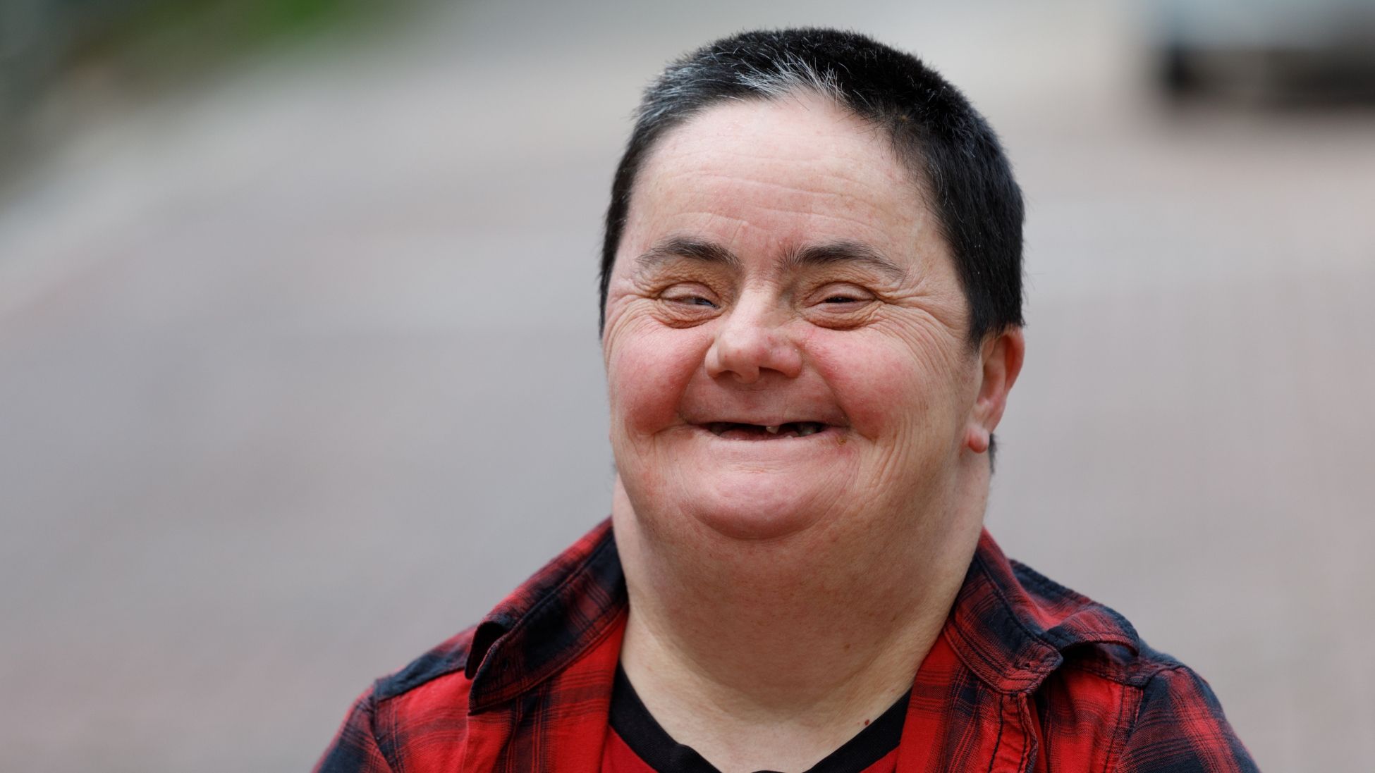 Mengenal Sindrom CLOVES, Dari Gejala hingga Pengobatan - KlikDokter