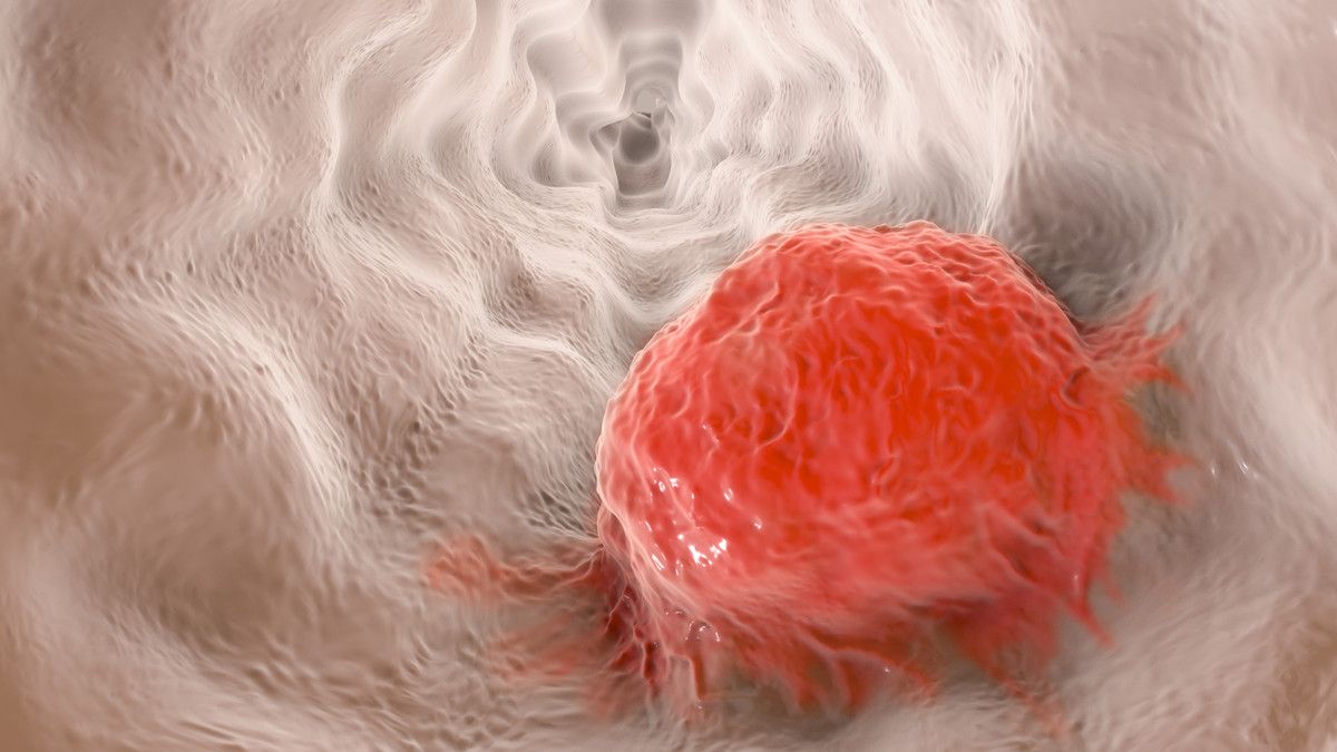 Kanker, Penyakit yang Sebabkan Kematian Tertinggi di Indonesia - KlikDokter