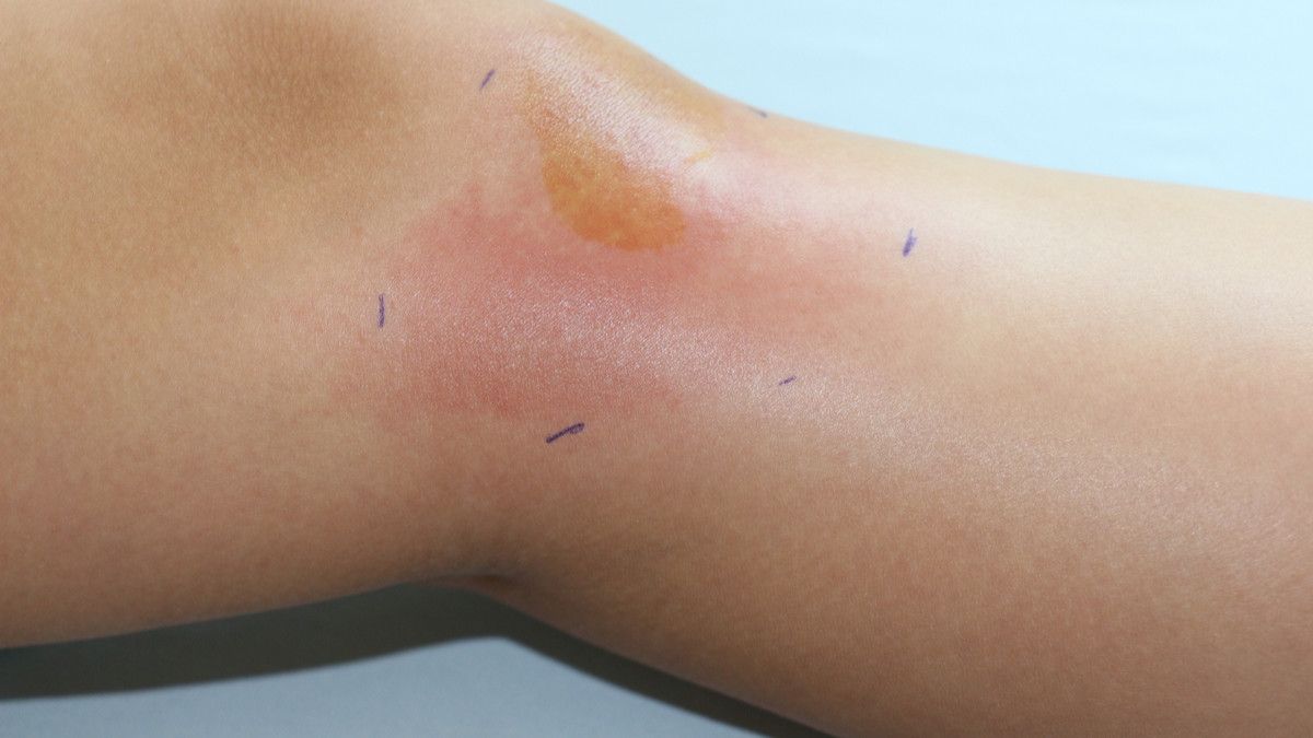 Serba-Serbi Selulitis, Infeksi Bakteri pada Kulit - KlikDokter