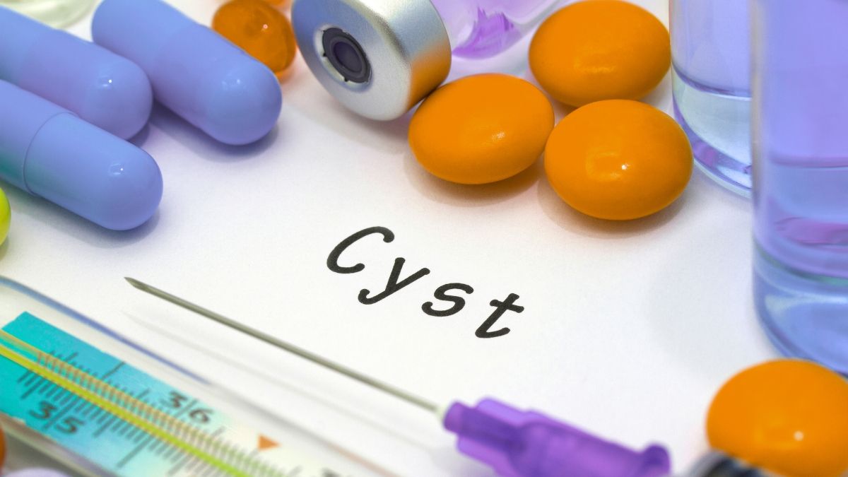 10 Penyebab Penyakit Kista yang Perlu Diwaspadai - KlikDokter