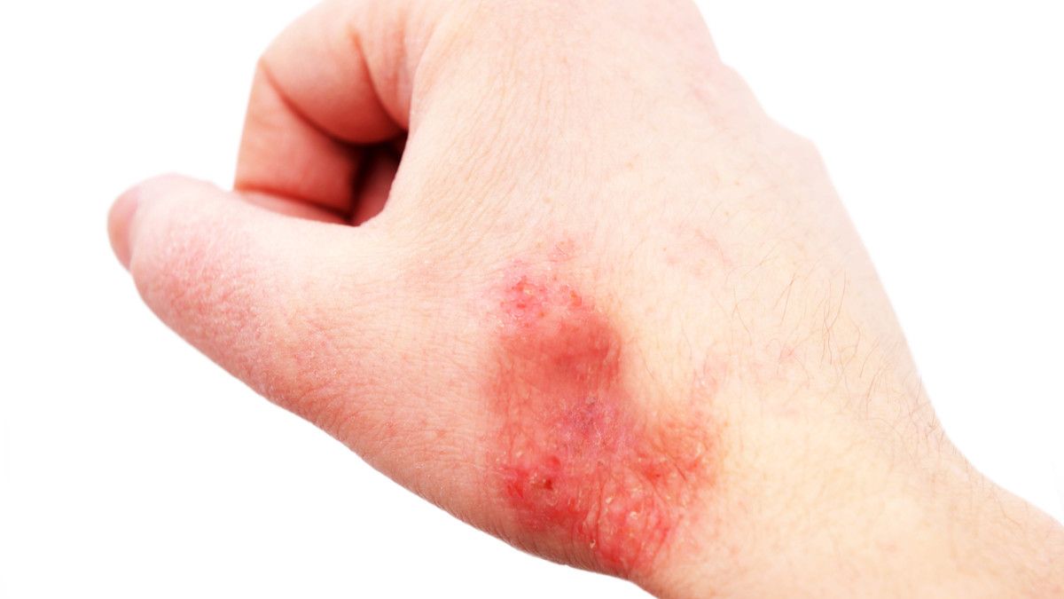 Jangan Salah, Ini Bedanya Eksim Kering dan Eksim Basah - KlikDokter