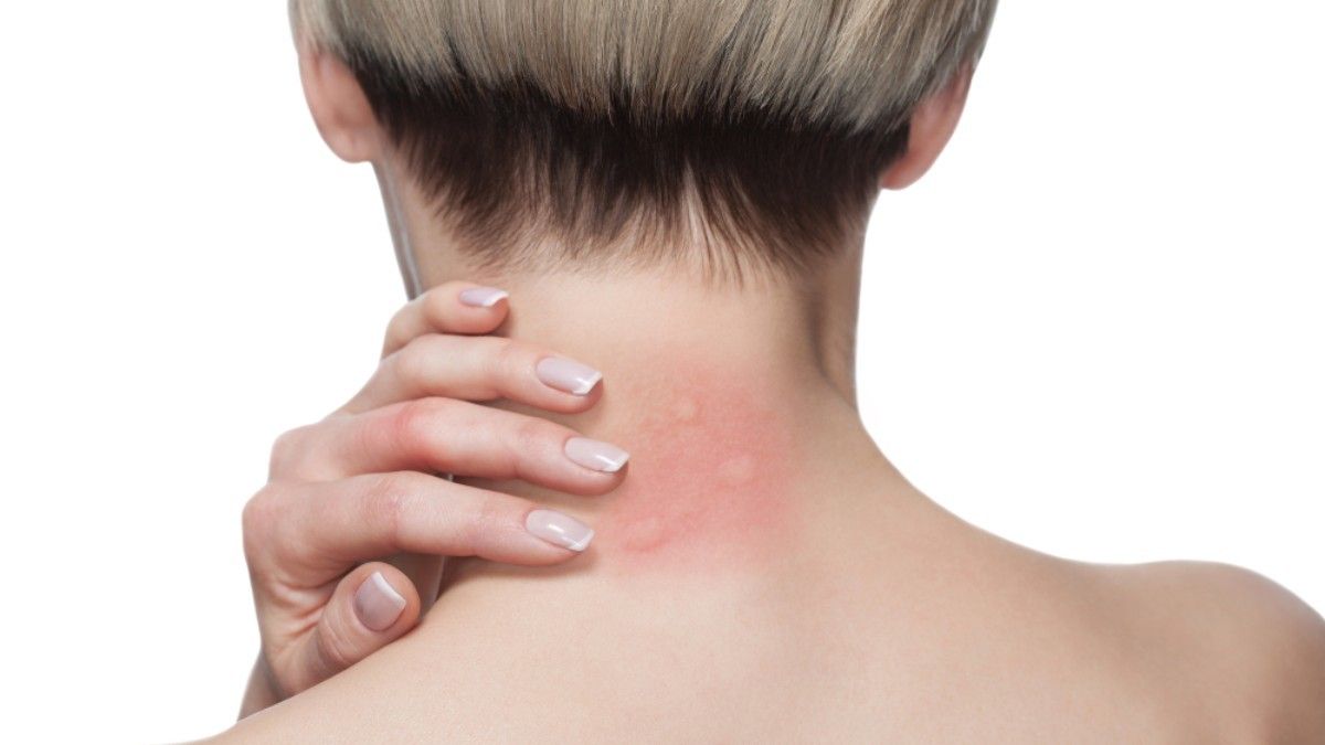 Ruam Kulit - Penyebab, Gejala, Pengobatan - KlikDokter