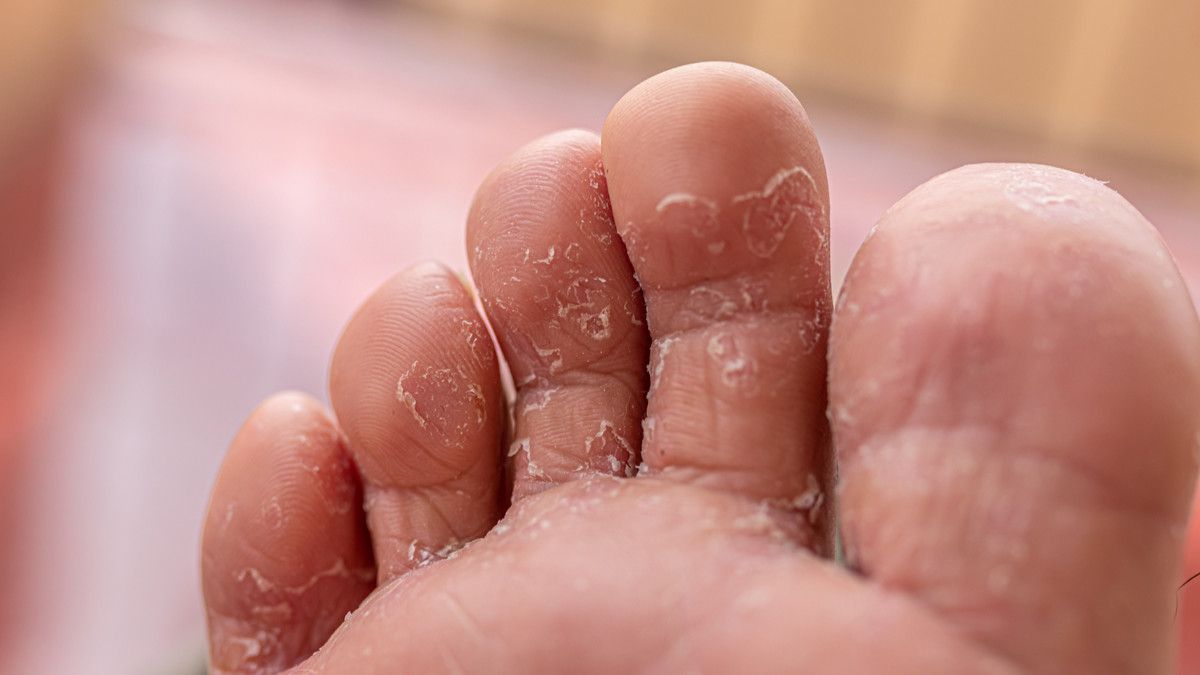 Kulit di Sela Jari Kaki Bersisik, Alergi atau Kutu Air? - KlikDokter
